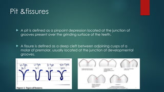 sealant therapydddddddddddddddddddd.pptx