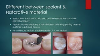 sealant therapydddddddddddddddddddd.pptx