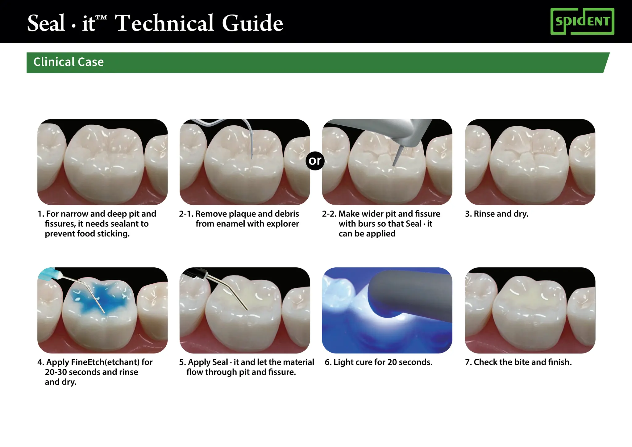 Seal it Technical Guide - Korean Pit and Fissure Sealent | PDF