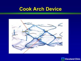 Fenestrated or branched prostheses in thoracic and abdominal aorta | PDF