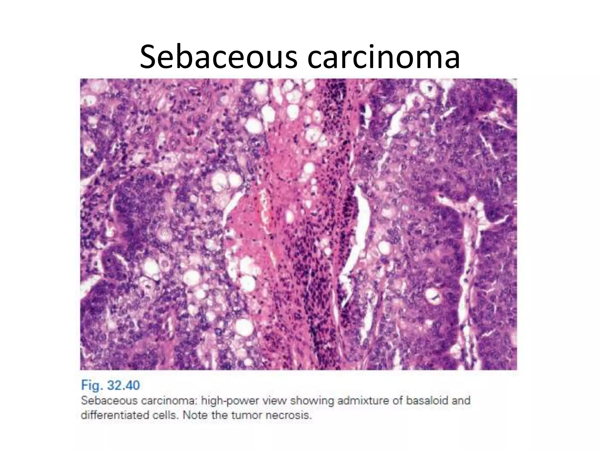 Sebaceous carcinoma 9.6.17