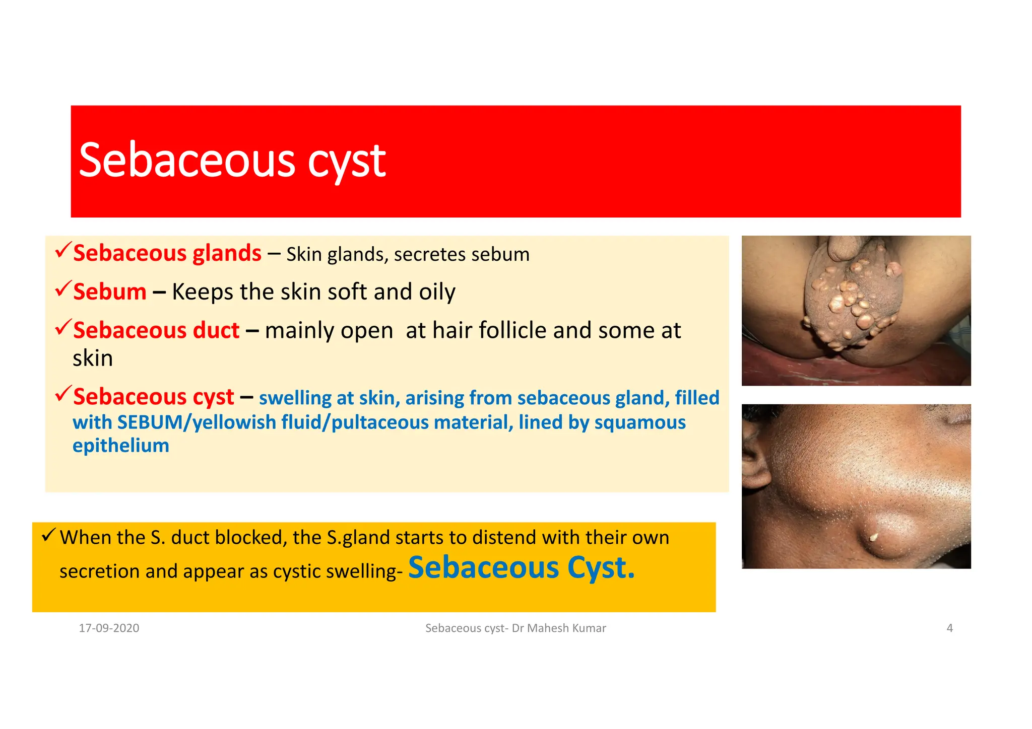 sebaceouscystdrmahesh-17-09-2020-200918161545.pdf