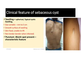 sebaceouscystdrmahesh-17-09-2020-200918161545.pdf