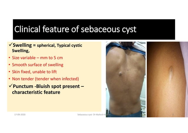 sebaceouscystdrmahesh-17-09-2020-200918161545.pdf