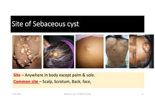 sebaceouscystdrmahesh-17-09-2020-200918161545.pdf