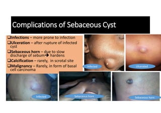 sebaceouscystdrmahesh-17-09-2020-200918161545.pdf