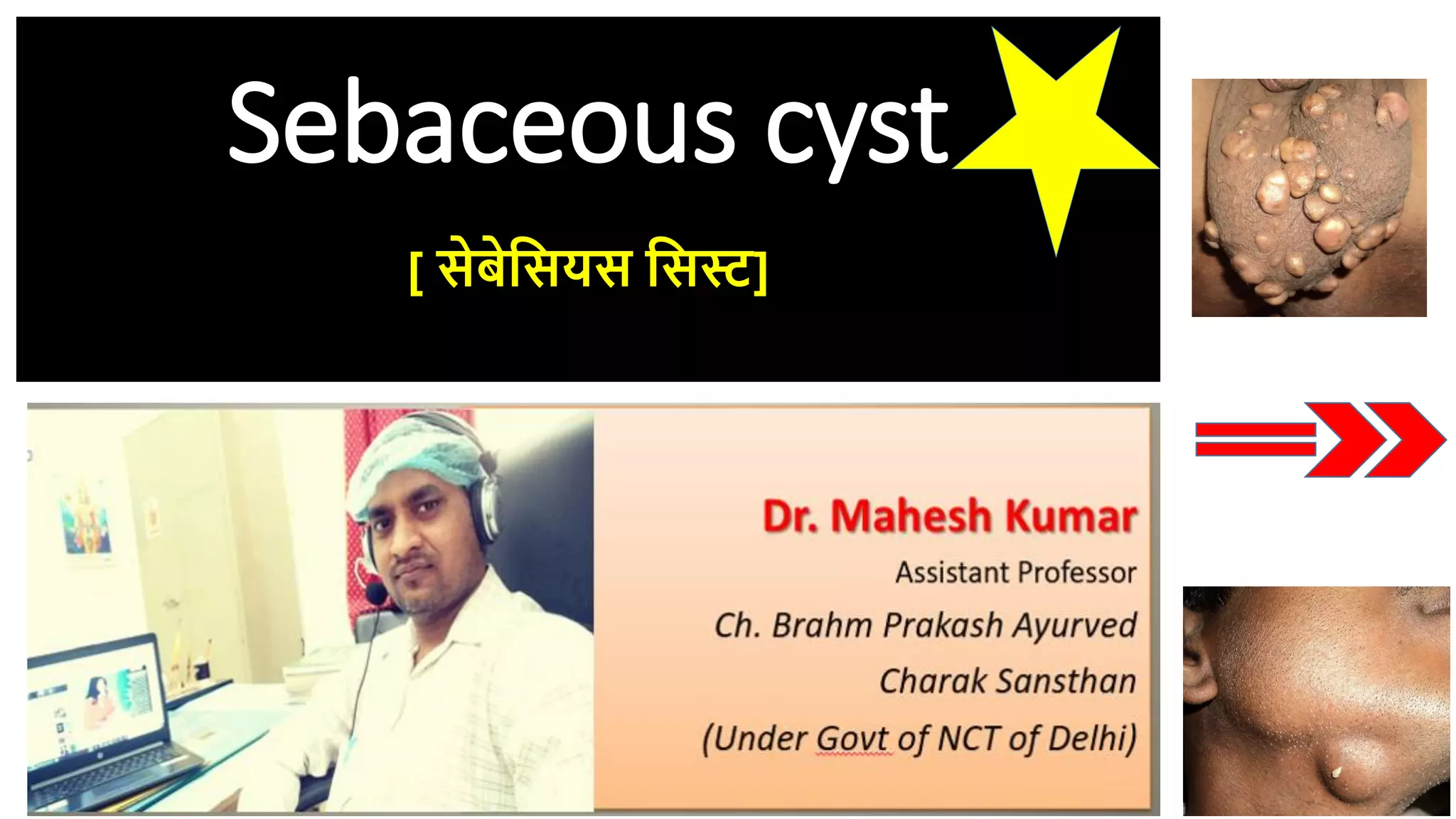Sebaceous cyst dr mahesh 17-09-2020 | PDF
