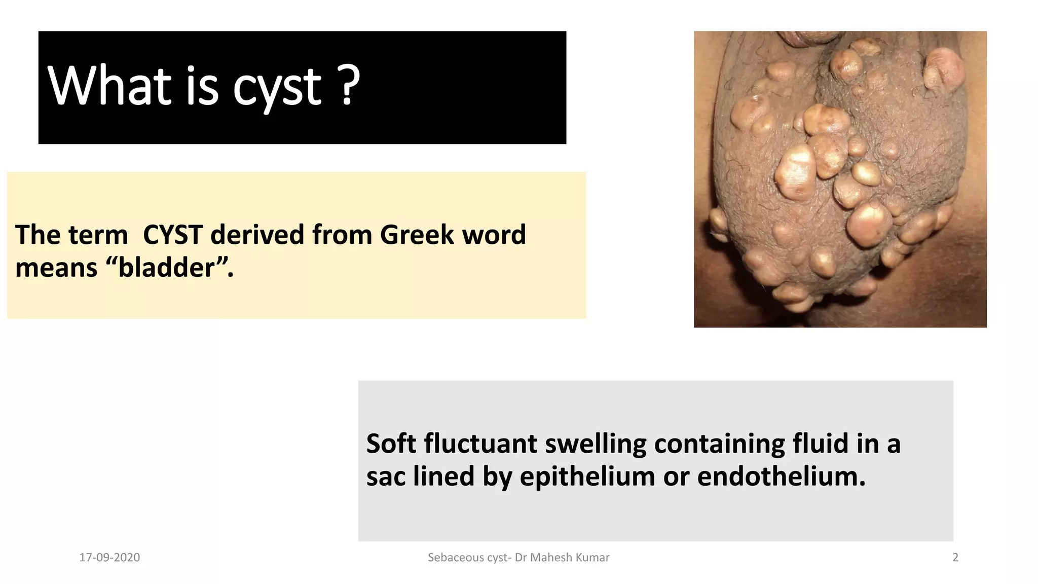 Sebaceous cyst dr mahesh 17-09-2020 | PDF