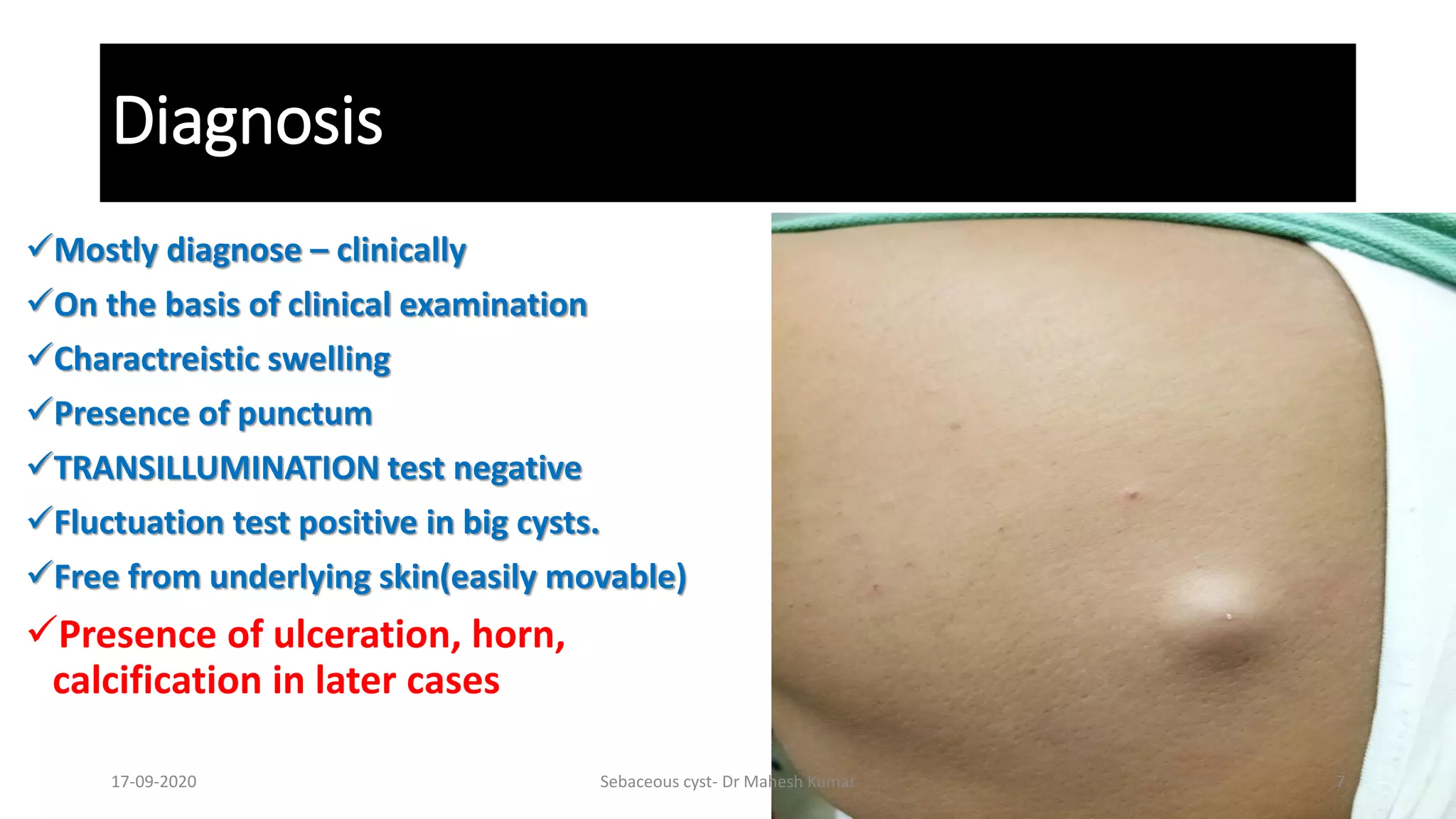 Sebaceous cyst dr mahesh 17-09-2020 | PDF