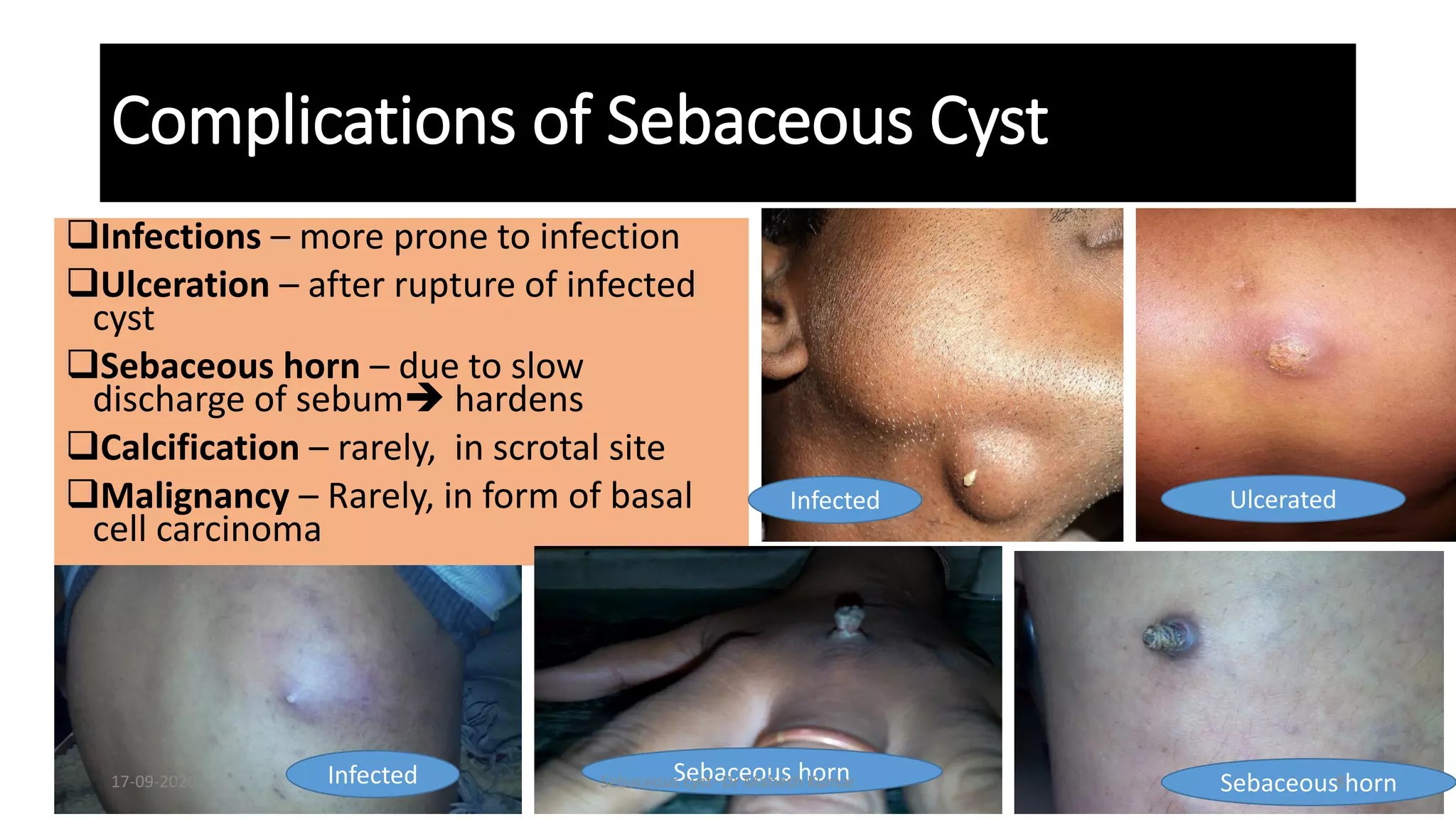 Sebaceous Cyst Dr Mahesh 17 09 2020 Pdf 7163