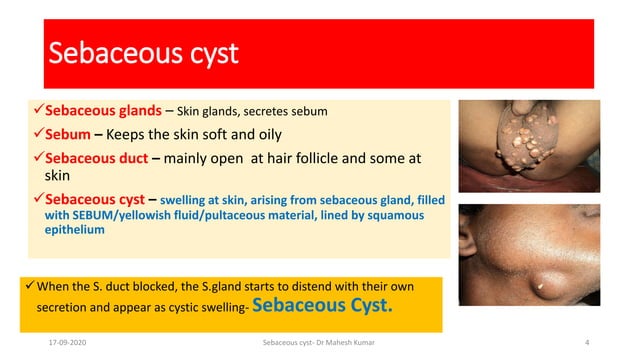 Sebaceous cyst dr mahesh 17-09-2020 | PDF