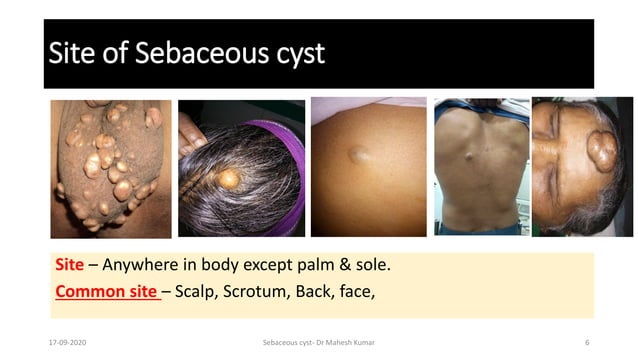 Sebaceous cyst dr mahesh 17-09-2020 | PDF