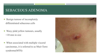 Sebaceous gland.pptx