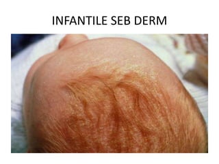 Seborrhoeic Dermatitis by Aseem | PPTX