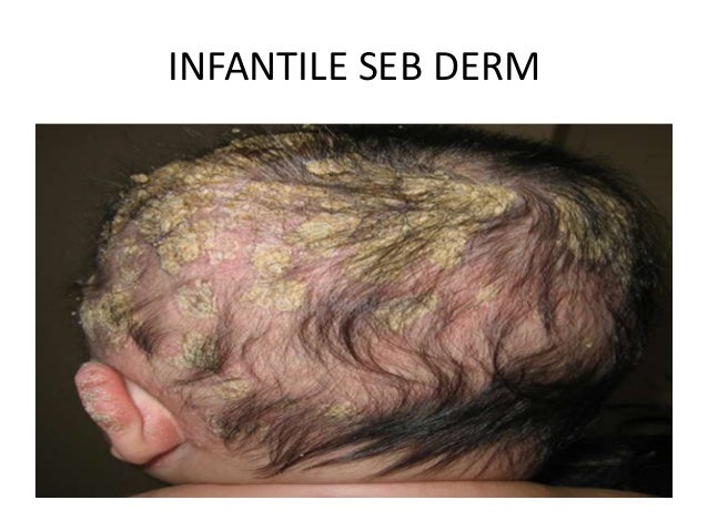 Seborrhoeic Dermatitis by Aseem