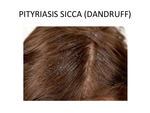 Seborrhoeic Dermatitis by Aseem