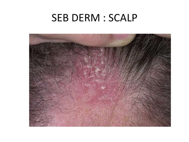 Seborrhoeic Dermatitis by Aseem