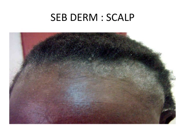 Seborrhoeic Dermatitis by Aseem