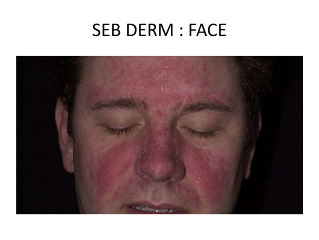 Seborrhoeic Dermatitis by Aseem