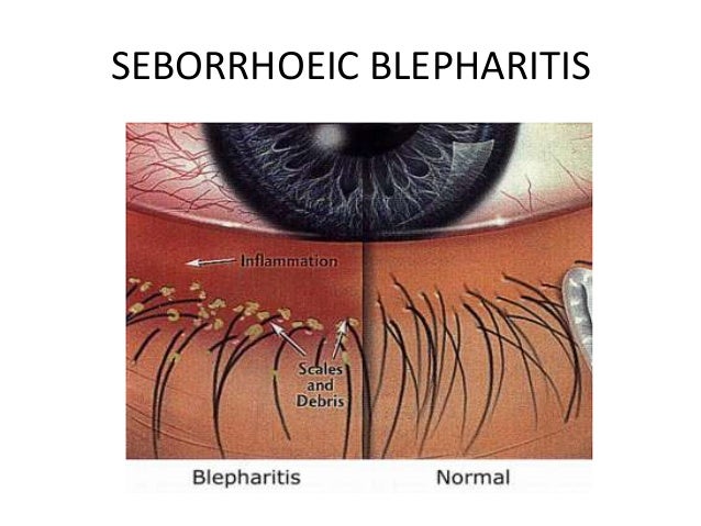 Seborrhoeic Dermatitis by Aseem