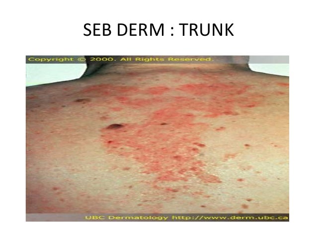 Seborrhoeic Dermatitis by Aseem