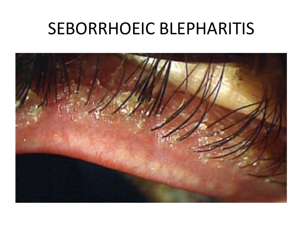 Seborrhoeic Dermatitis by Aseem