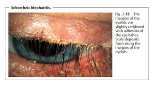 Seborrheic blephritish by upendra pal .pdf