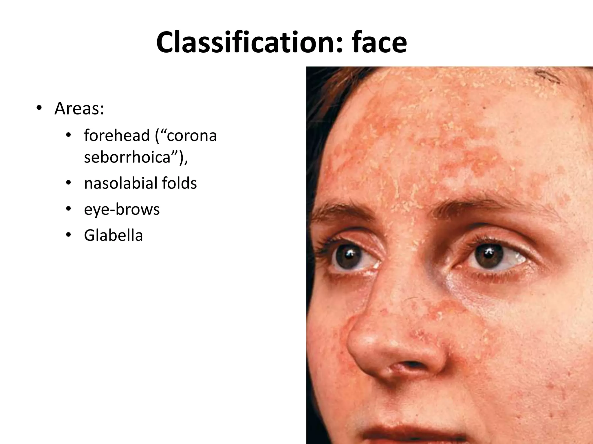 Seborrheic dermatitis | PPTX