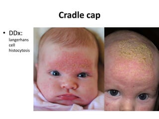 Neonatal Seborrheic Dermatitis