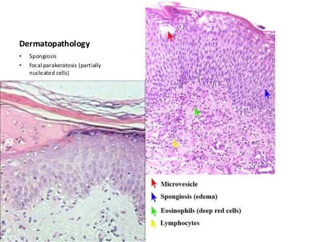 Seborrheic dermatitis
