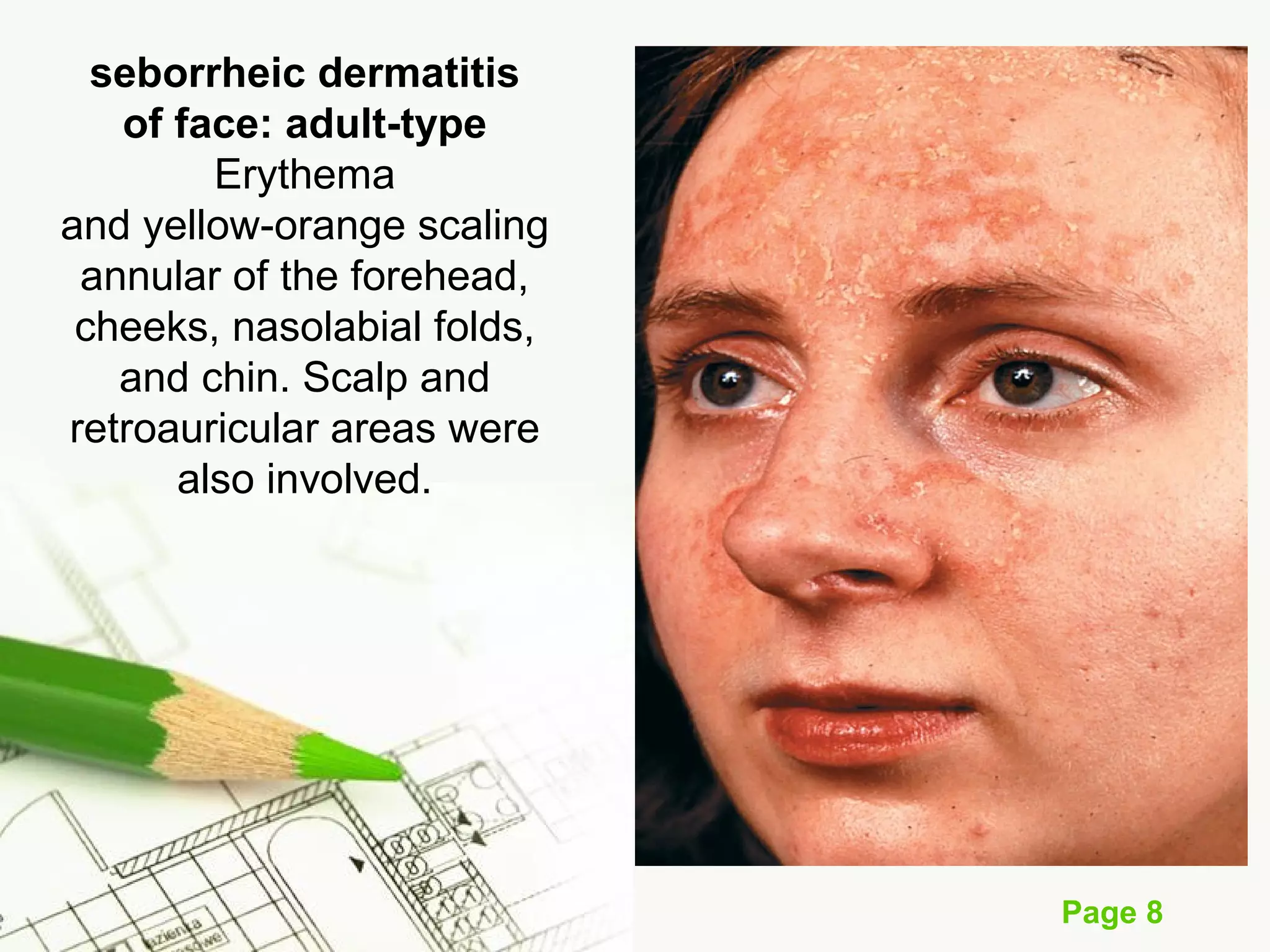 Seborrheic dermatitis | PPT