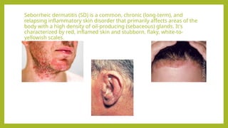 Seborrheic dermatitis causes and treatments.pptx