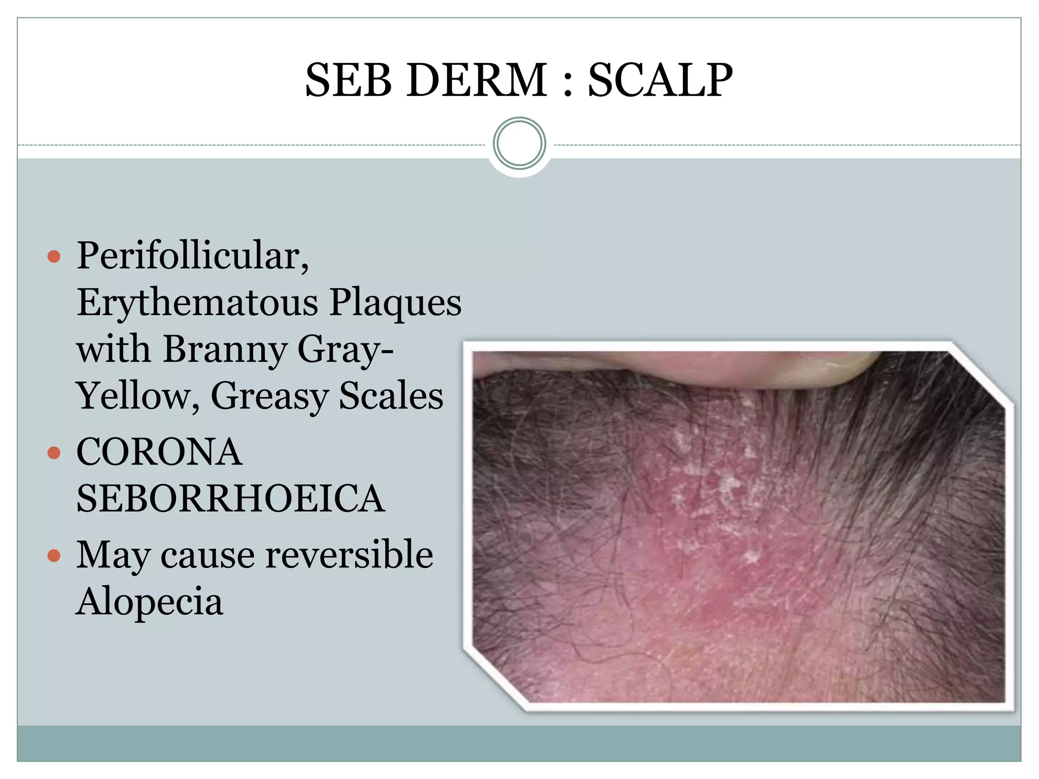 Seborrhoeic Dermatitis | PPTX