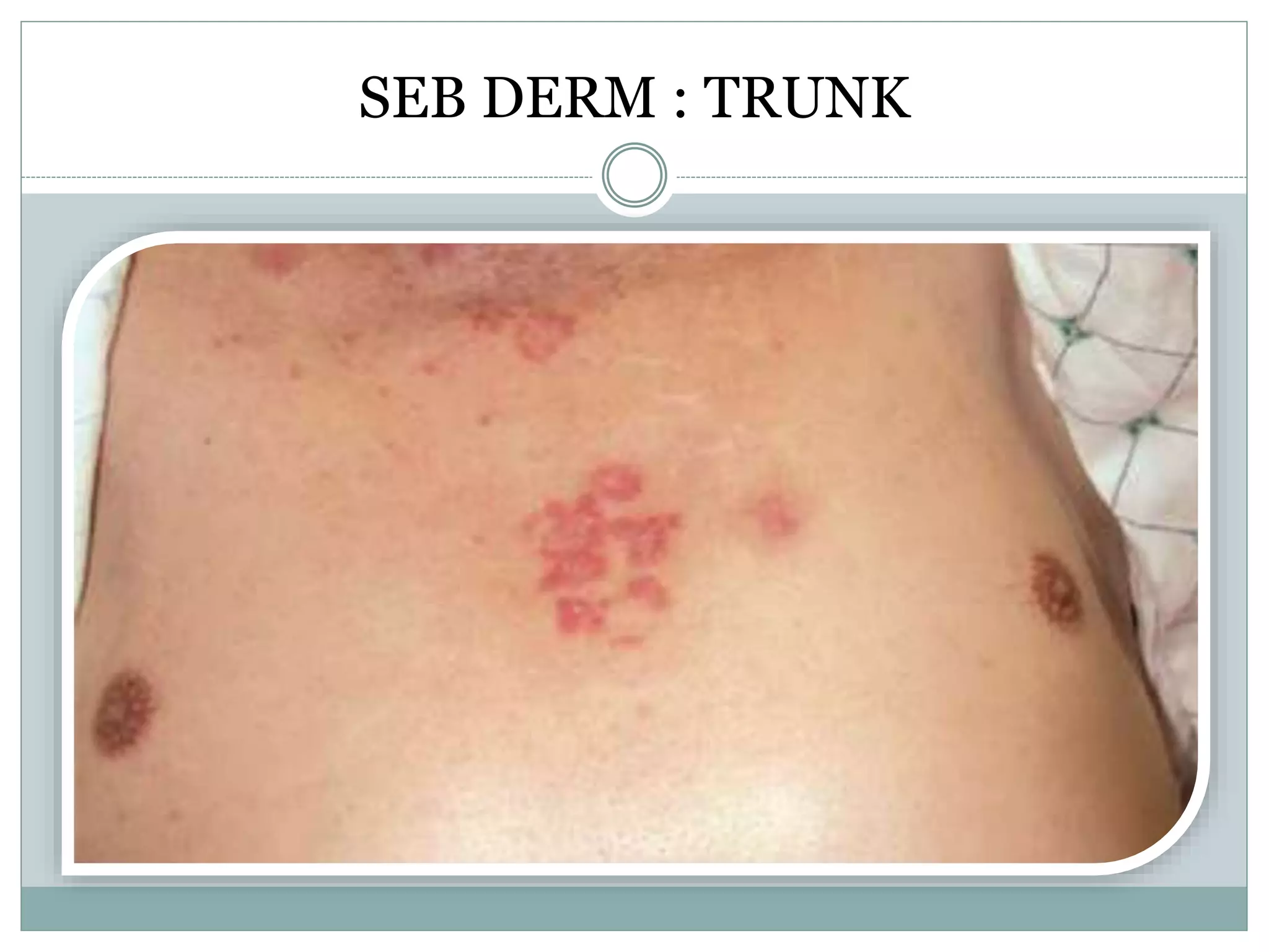 Seborrhoeic Dermatitis | PPTX | Skin and Dermatology | Diseases and ...