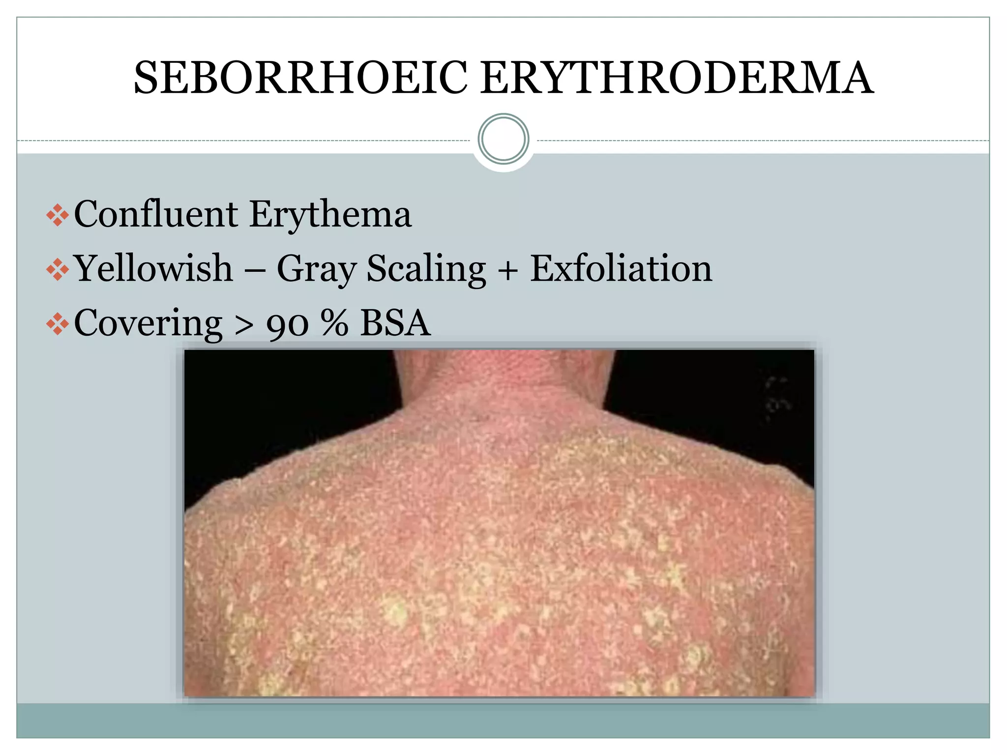 Seborrhoeic Dermatitis | PPTX