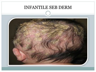 Seborrhoeic Dermatitis | PPTX
