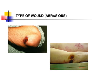 Sec1.fa4 wounds & bleeding | PPT