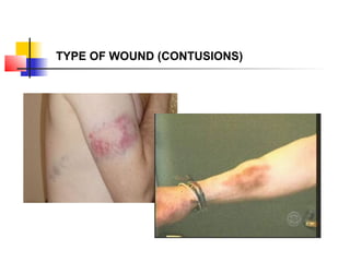 Sec1.fa4 wounds & bleeding | PPT