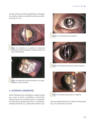 Sección 5. cristalino | PDF