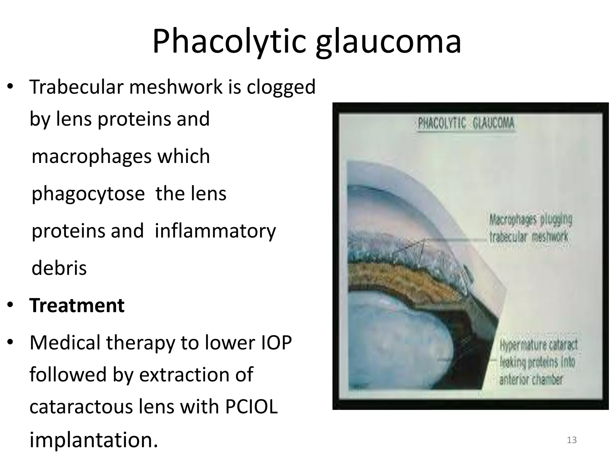 Secondary-glaucoma-Final.pptx