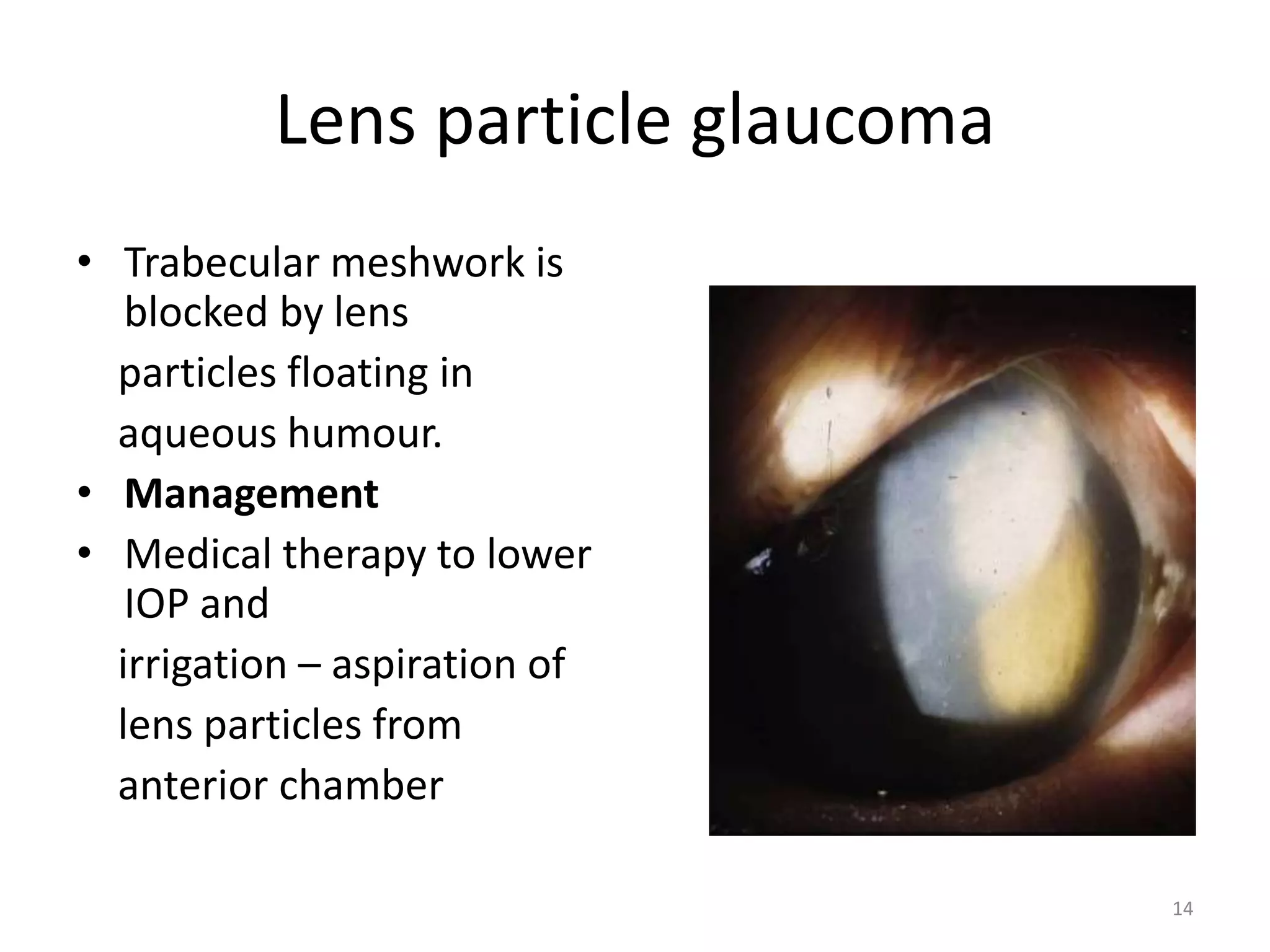 Secondary-glaucoma-Final.pptx