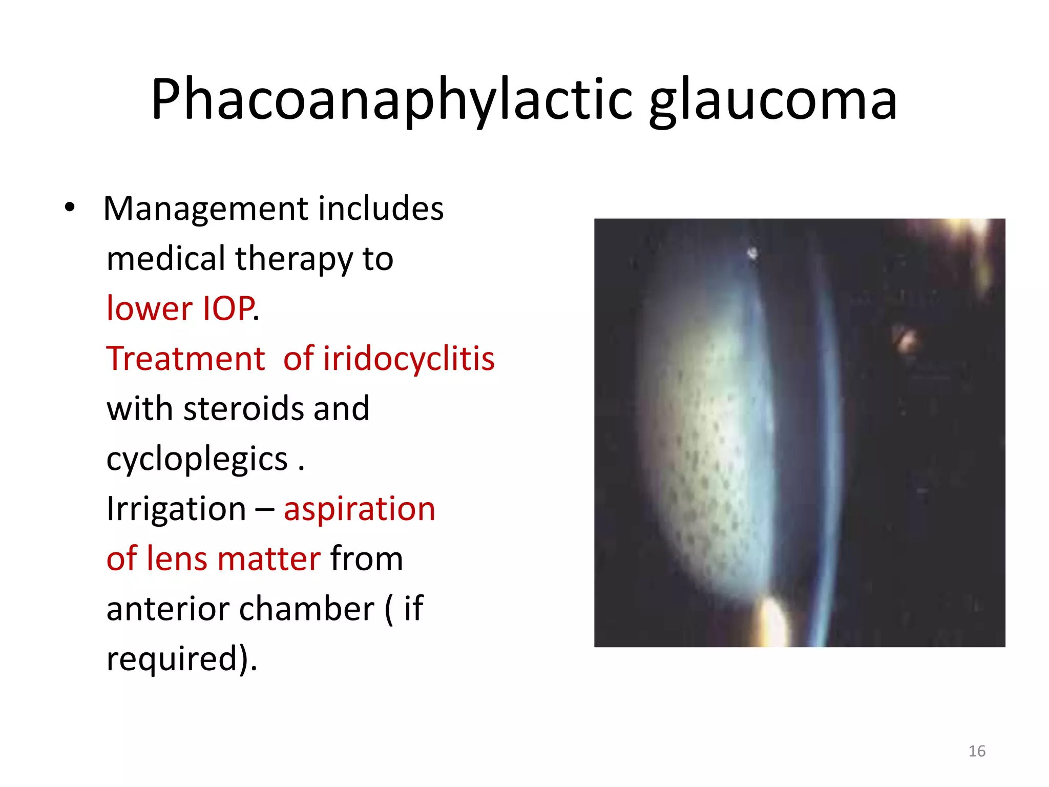 Secondary-glaucoma-Final.pptx