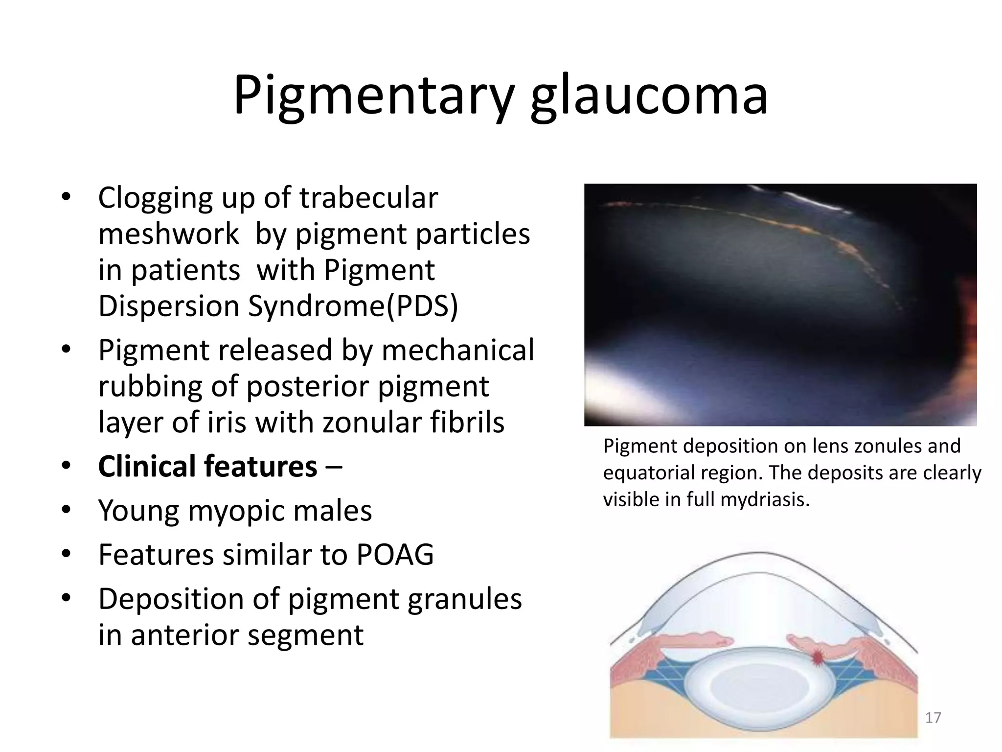 Secondary-glaucoma-Final.pptx