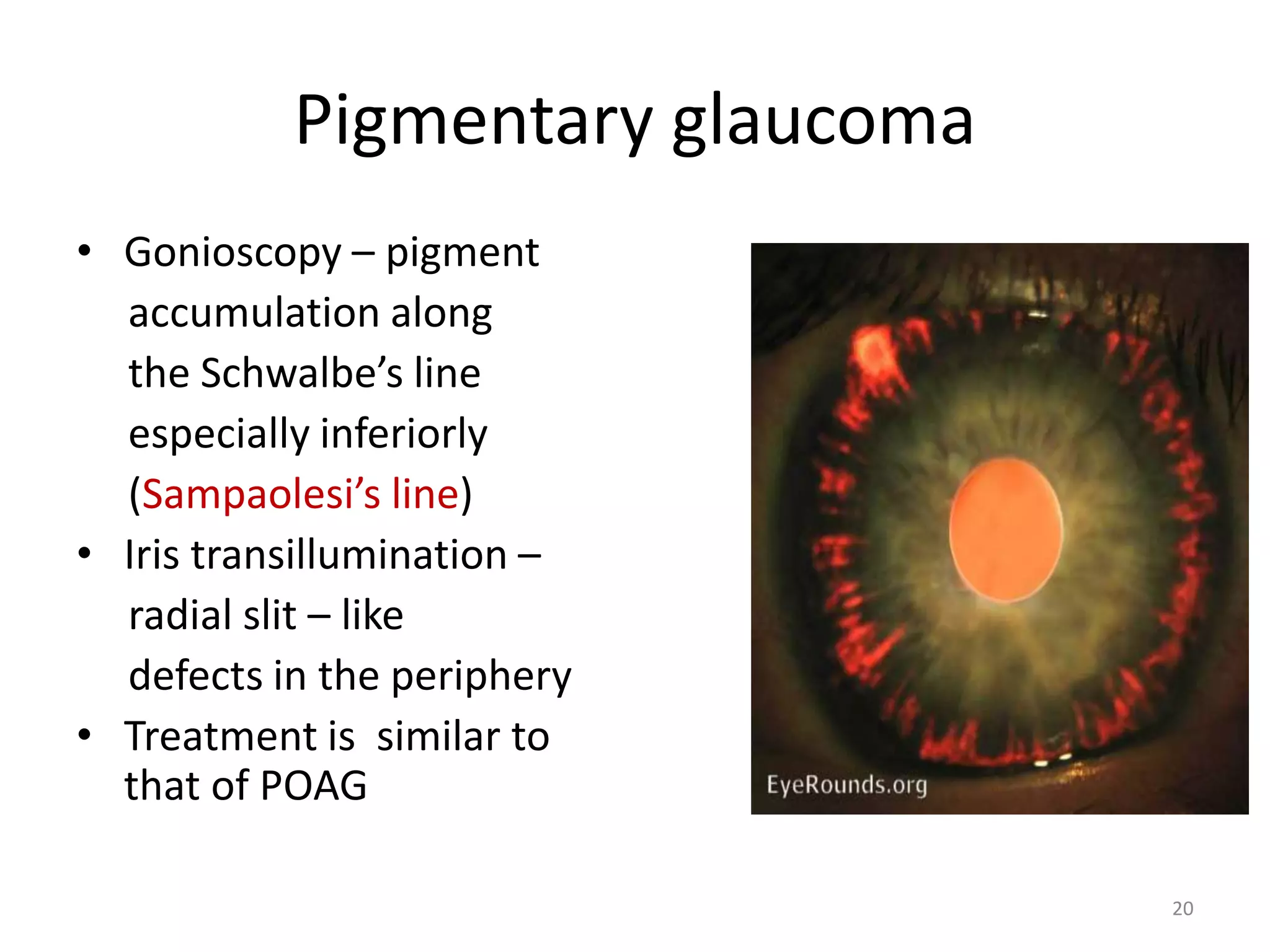 Secondary-glaucoma-Final.pptx