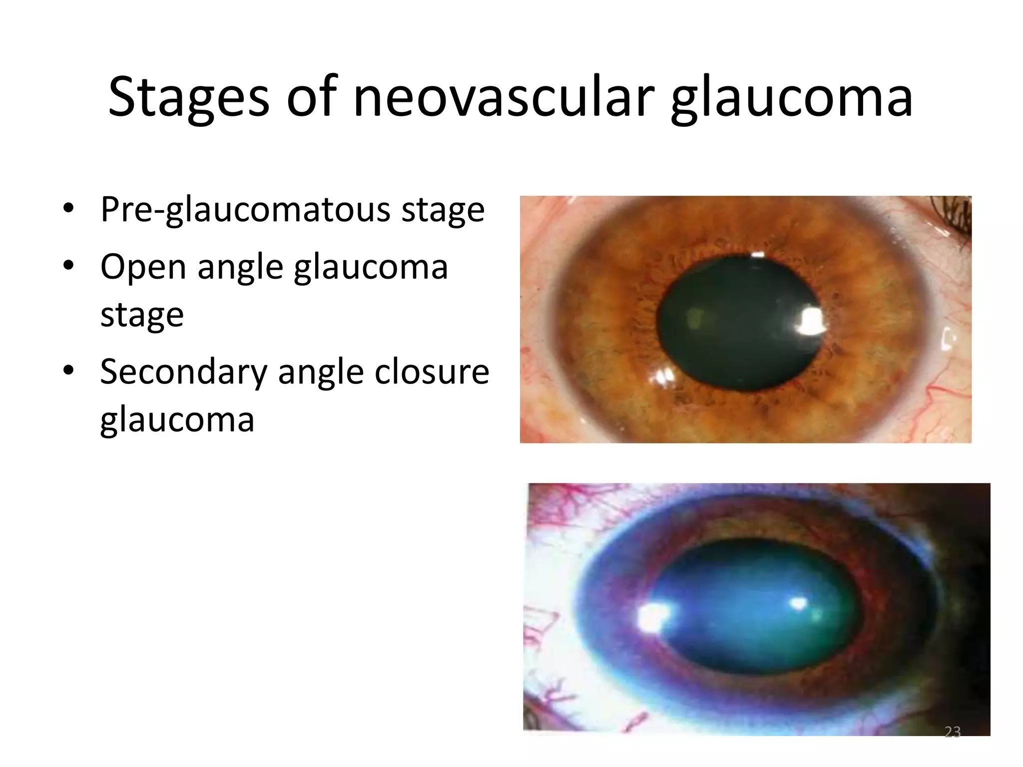 Secondary-glaucoma-Final.pptx