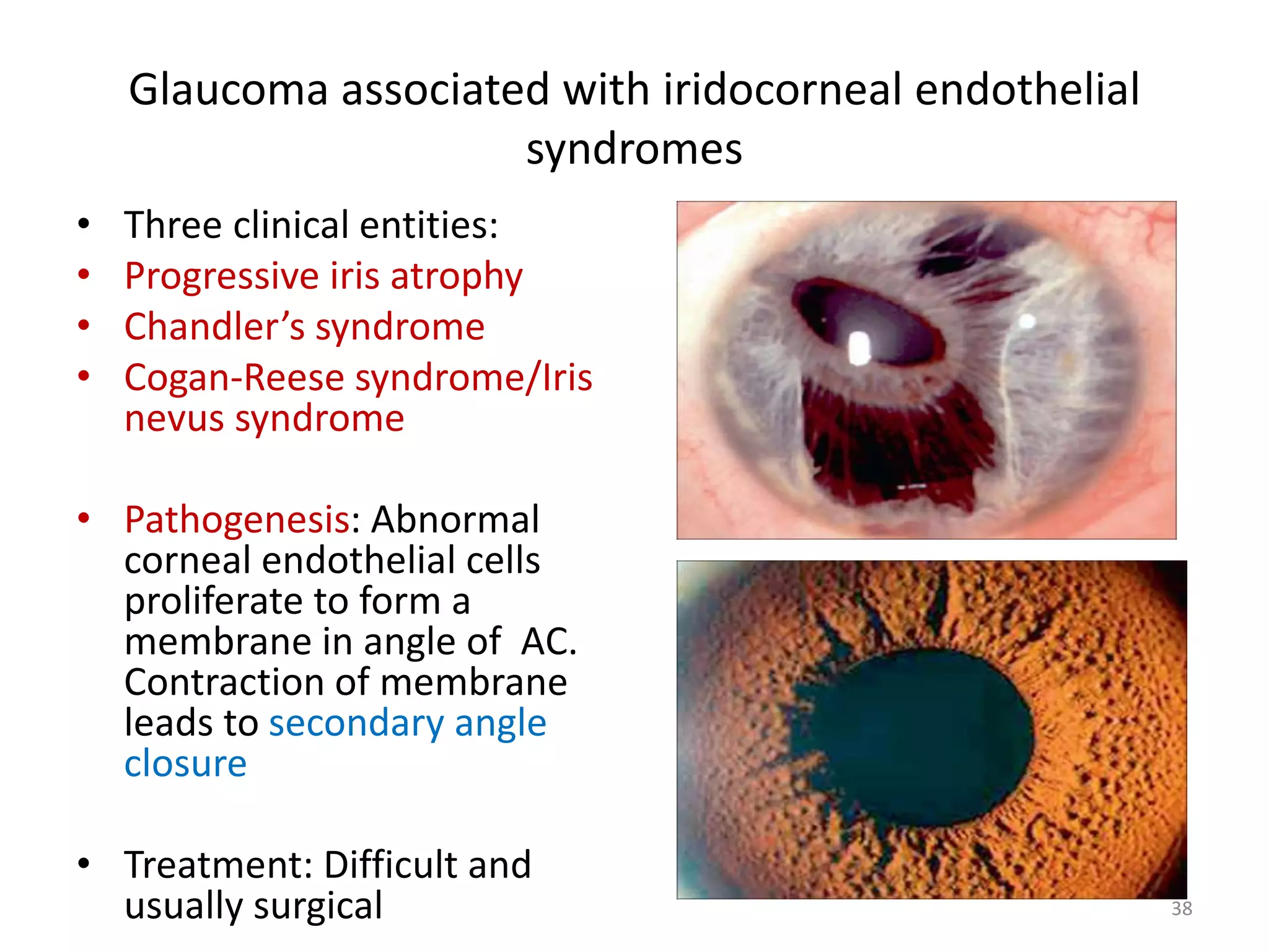 Secondary-glaucoma-Final.pptx