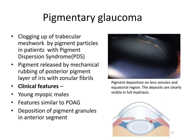 Secondary-glaucoma-Final.pptx | Eye and Vision Conditions | Diseases and Conditions