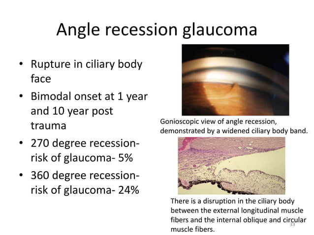 Secondary-glaucoma-Final.pptx | Eye and Vision Conditions | Diseases and Conditions