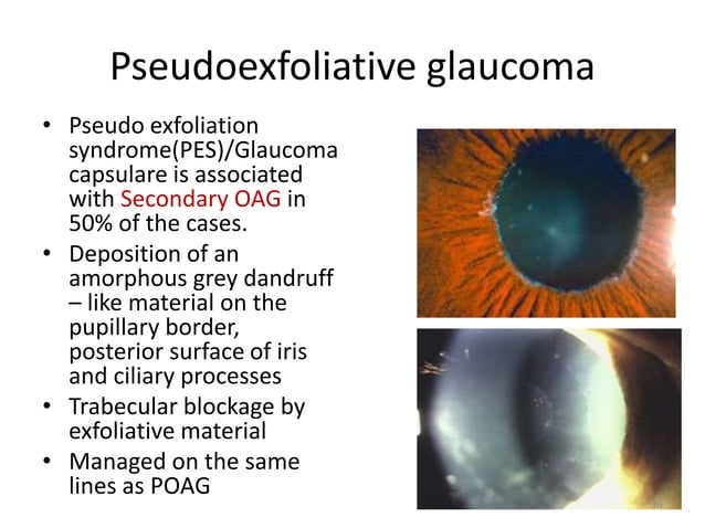 Secondary-glaucoma-Final.pptx | Eye and Vision Conditions | Diseases and Conditions