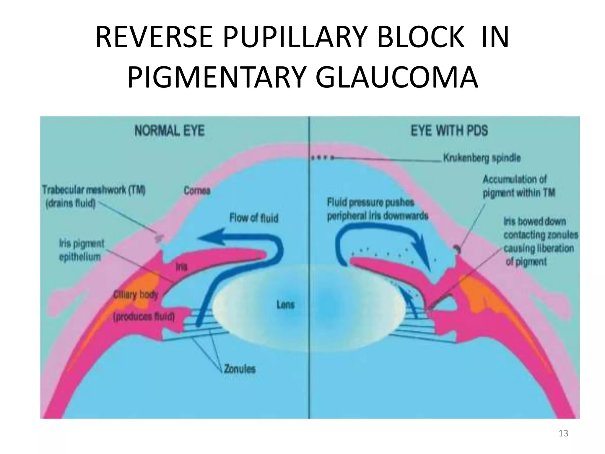 Secondary-glaucoma-Final.pptx